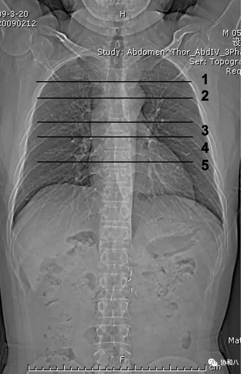 Tomography of the lung window of the chest CT can help us identify the ...