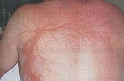 If you are hit by lightning, a red "special mark" will be left on the ...