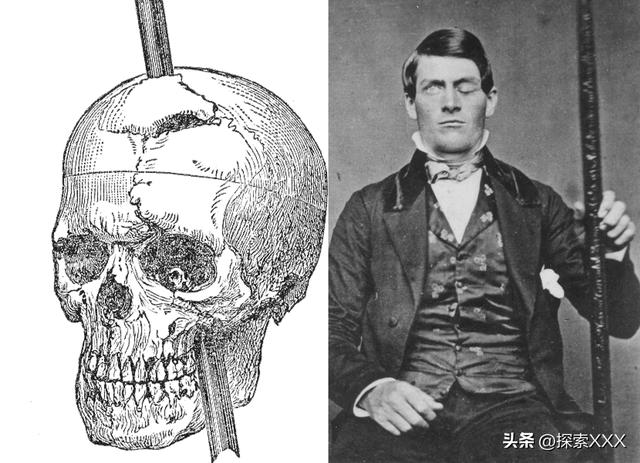 Have you heard of Phoenias Gage? This is an interesting case, which ...