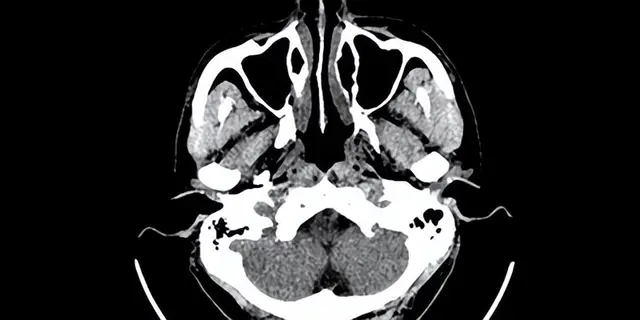Gamma Knife radiosurgery is an advanced surgical technique in which a ...