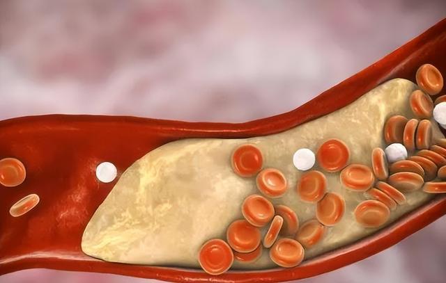 Hyperlipidemia is a common chronic cardiovascular disease, and ...