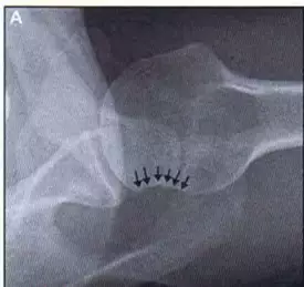 特殊名称骨折这么多，你都能记住吗？ - 标件库