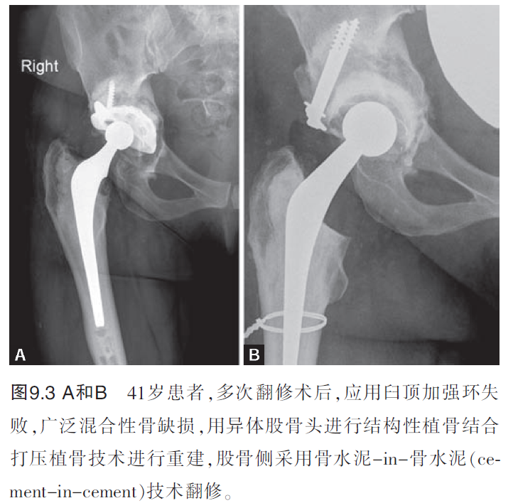 髋臼翻修之骨水泥重建（上篇） - 标件库
