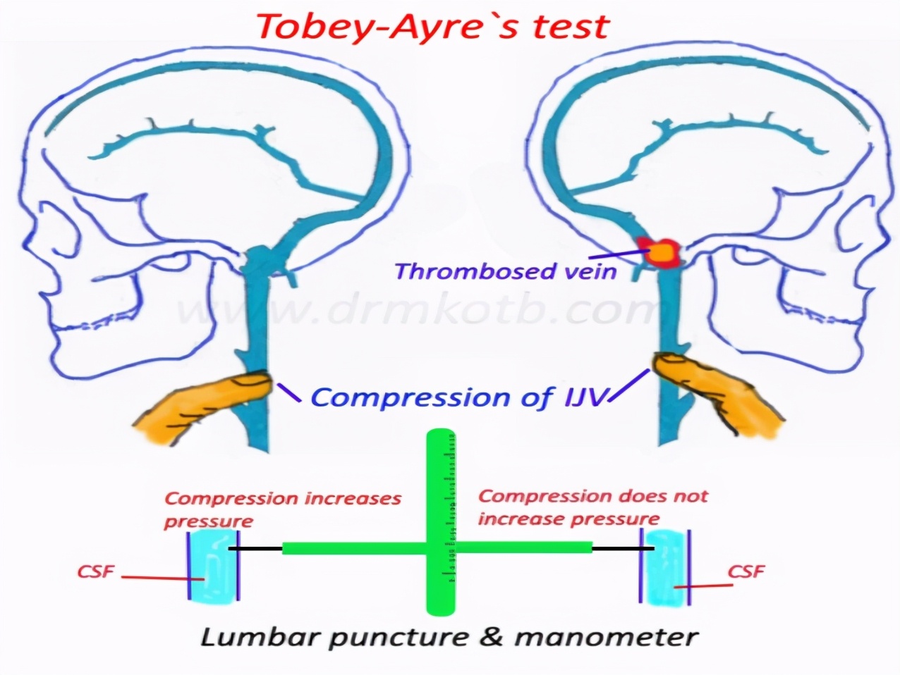 压颈试验（Queckenstedt test） - 液压汇