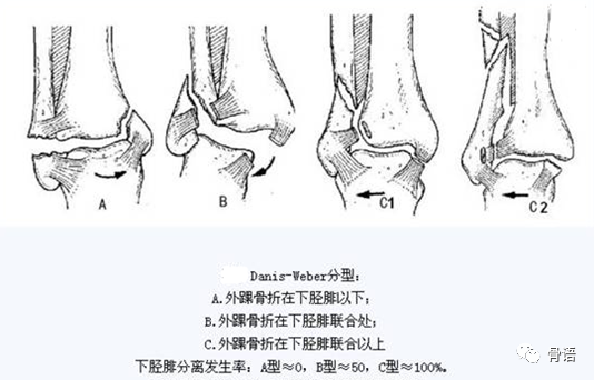 浅谈老年骨质疏松性踝关节骨折的诊断与治疗 - 标件库