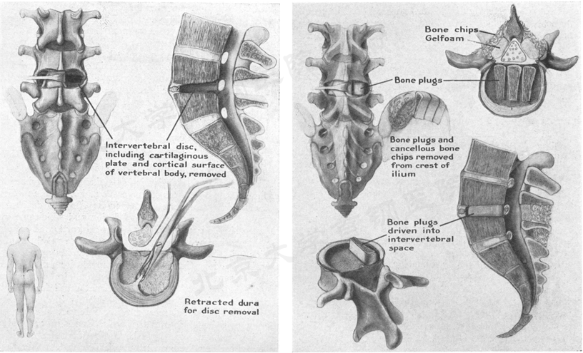 UBE/BESS下腰椎融合术的种类、溯源及对比（上） - 标件库